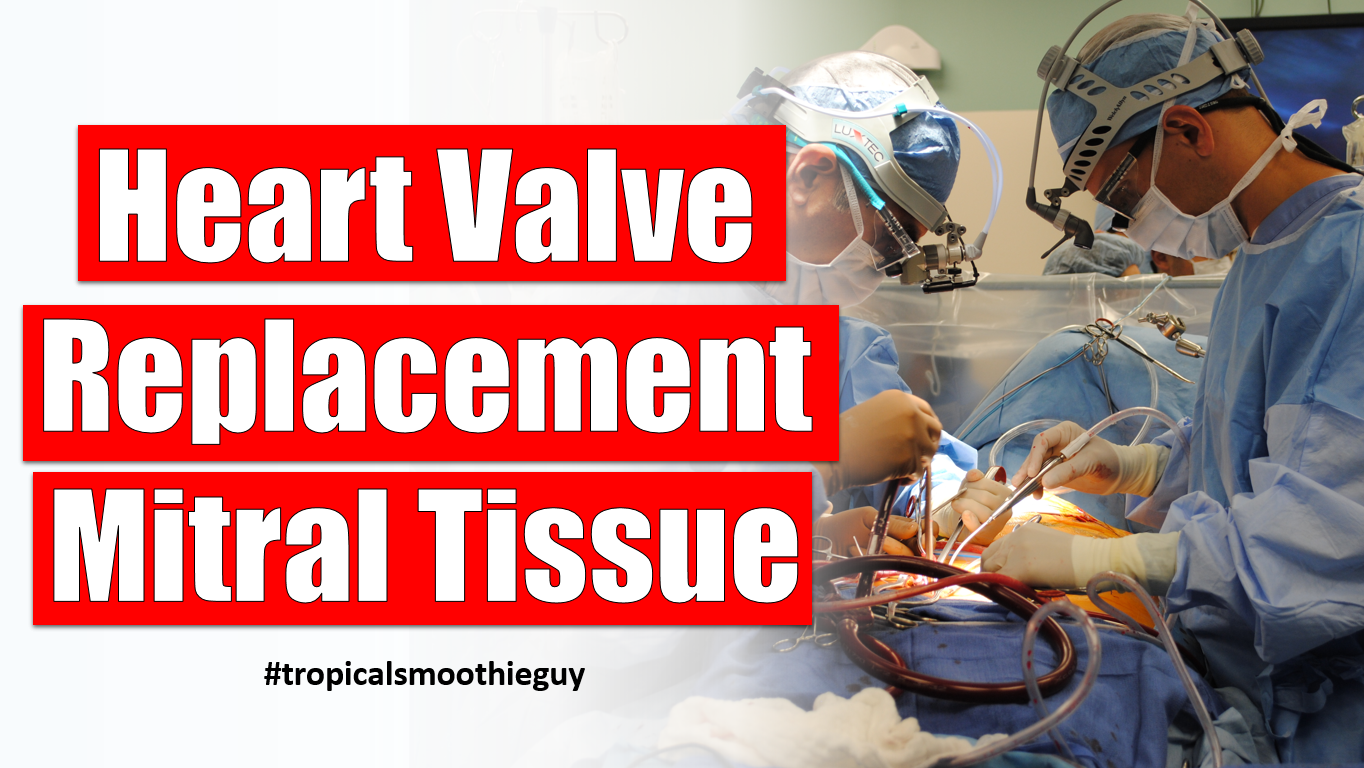 How Heart Valve Replacement Works Through Mitral Tissue How Heart Valve Replacement Works Through Mitral Tissue